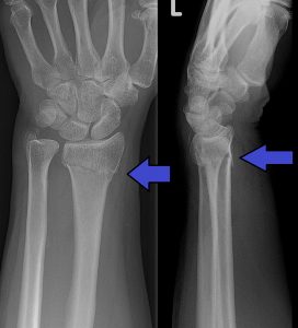 Explaining What Smith's Fracture Is - Physioroom Blog