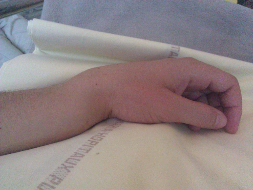 Explaining What Smith's Fracture Is - Physioroom Blog