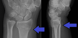 Explaining What Smith's Fracture Is - Physioroom Blog